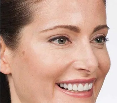 Burlington MA Botox Before and After Photos - Cambridge Plastic Surgery ...